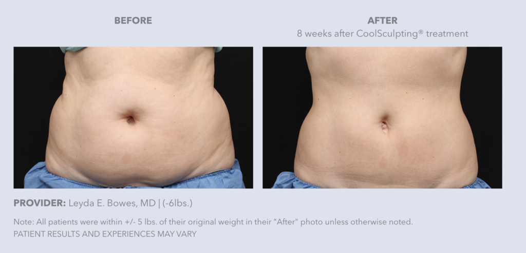 CoolSculpting - Deja You Medical Aesthetics